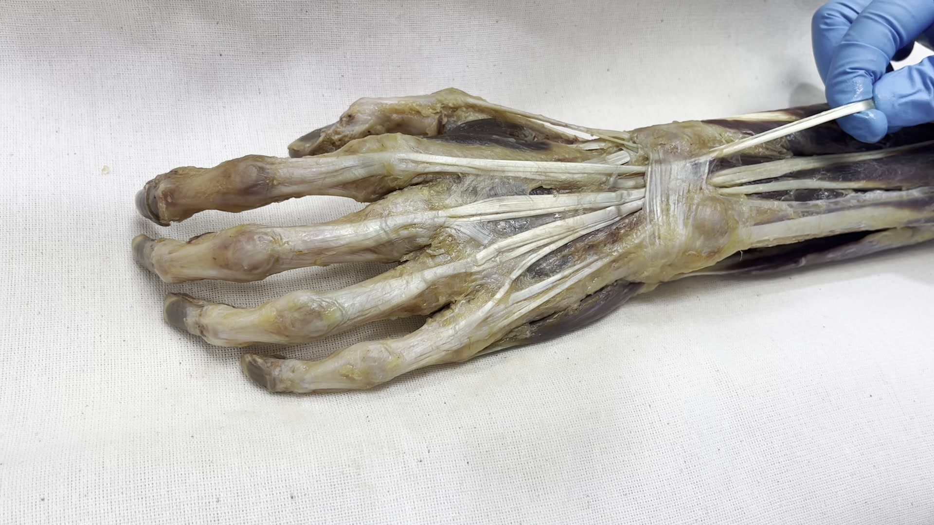Extensor Pollicis Longus Cadaver