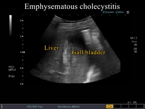 Emphysematous Cholecystitis Ultrasound