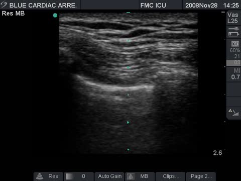 Curvilinear Probe Ultrasound Slide