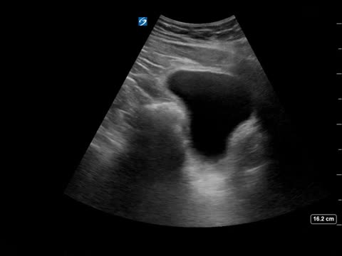 Abnormal Bladder Ultrasound