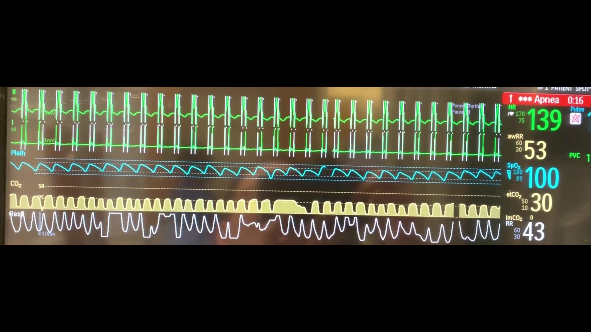 Asystole Monitor