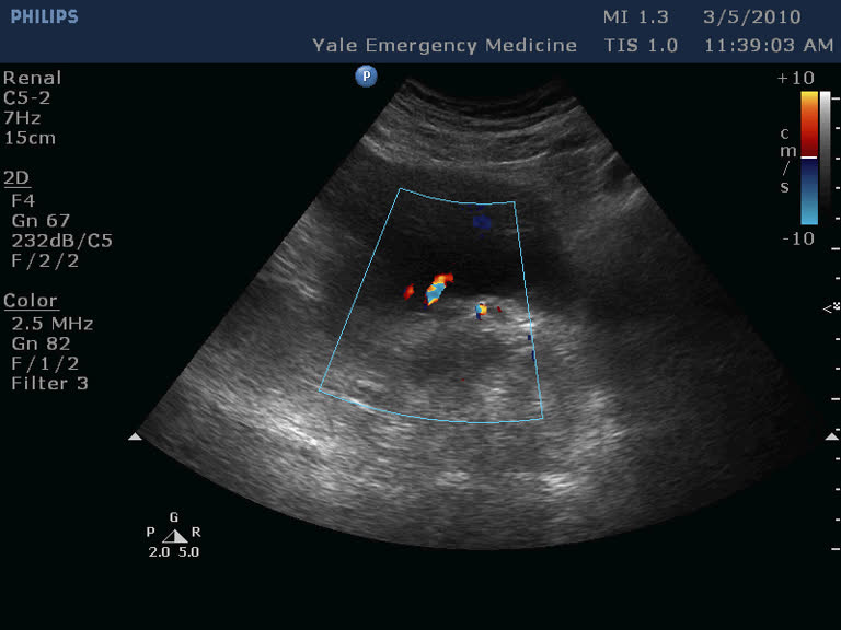 Bladder Stone Ultrasound