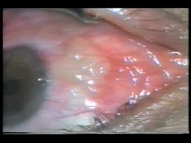 Hookworm In Human Eye