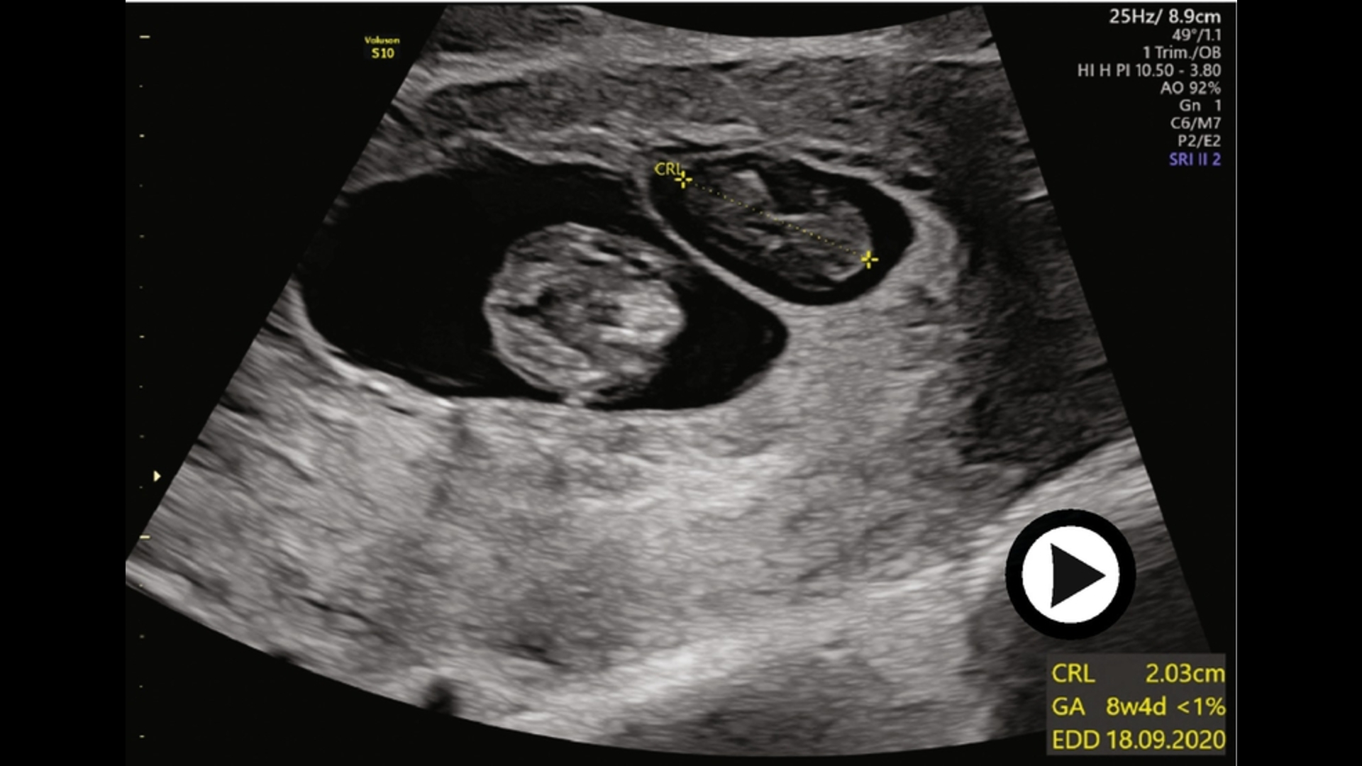 Vanishing Twin Syndrome