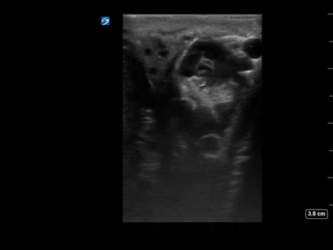 Pyocele Ultrasound