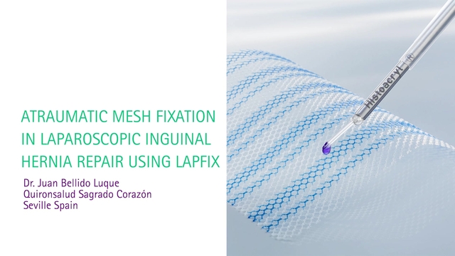 D-CT21005 Histoacryl LAPFIX How to use video.mp4 – Video