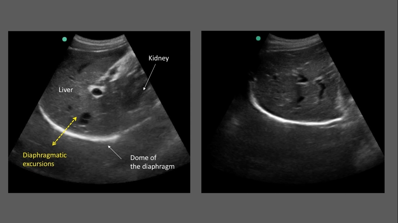 Transverse Liver Ultrasound Diaphragm
