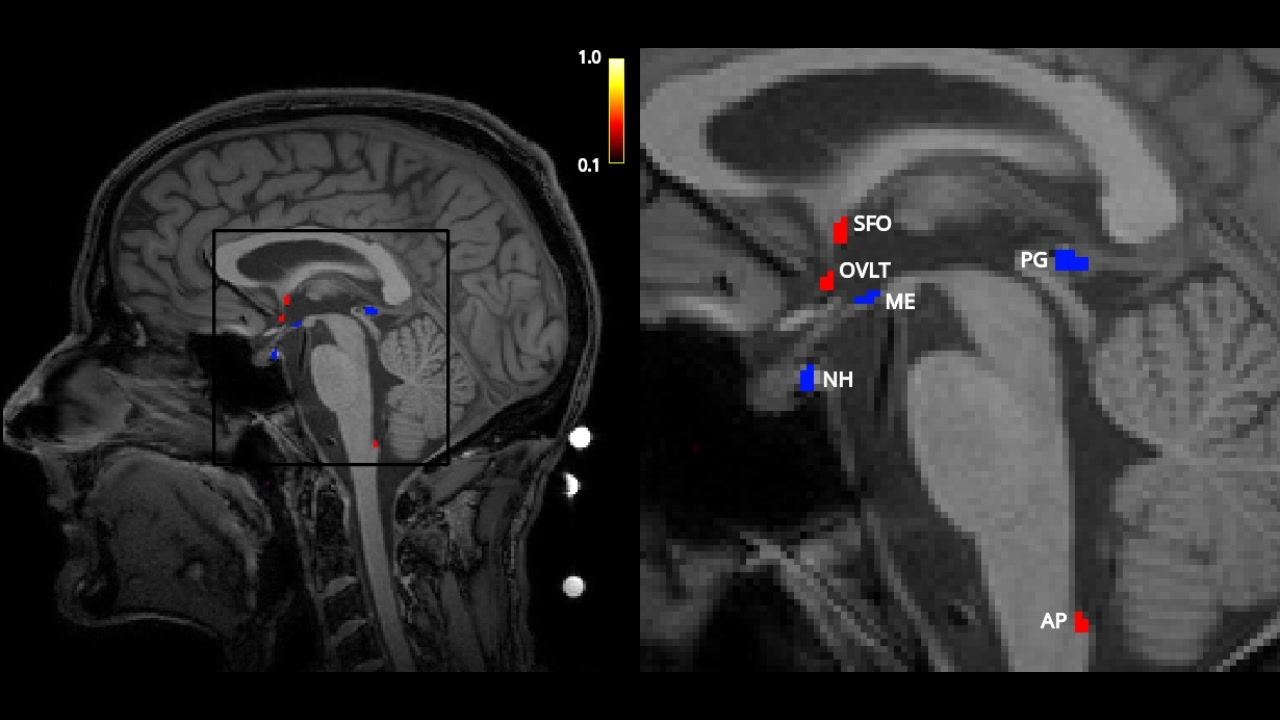 Lamina Terminalis Mri
