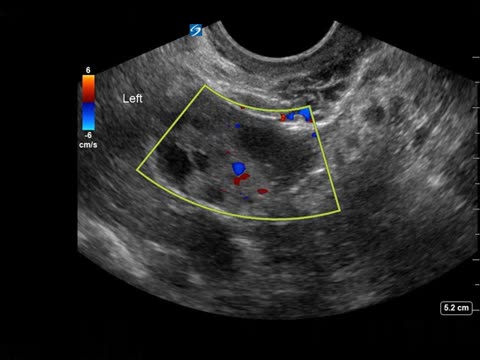 Rectouterine Pouch Ultrasound