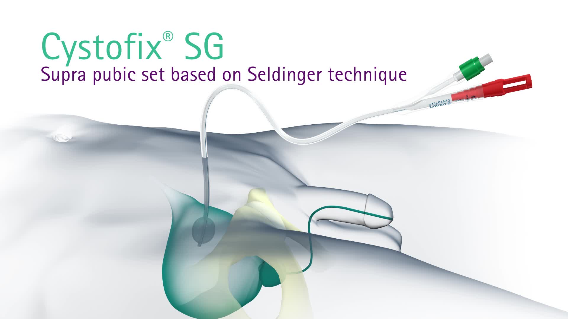 Cystofix Suprapubic Catheter
